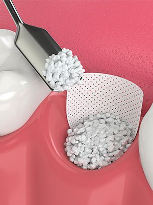 Oral Surgery in Los Angeles | Wilshire Oral Surgery and Implant Center