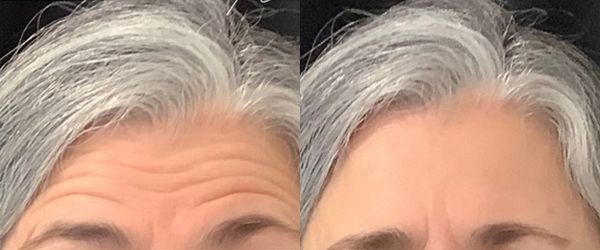 Botox & Fillers in LaGrange | LaGrange Botox