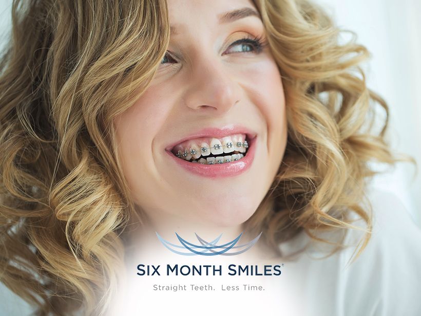 Six Month Smiles Clear Braces at Yap Family Dental in Buena Park