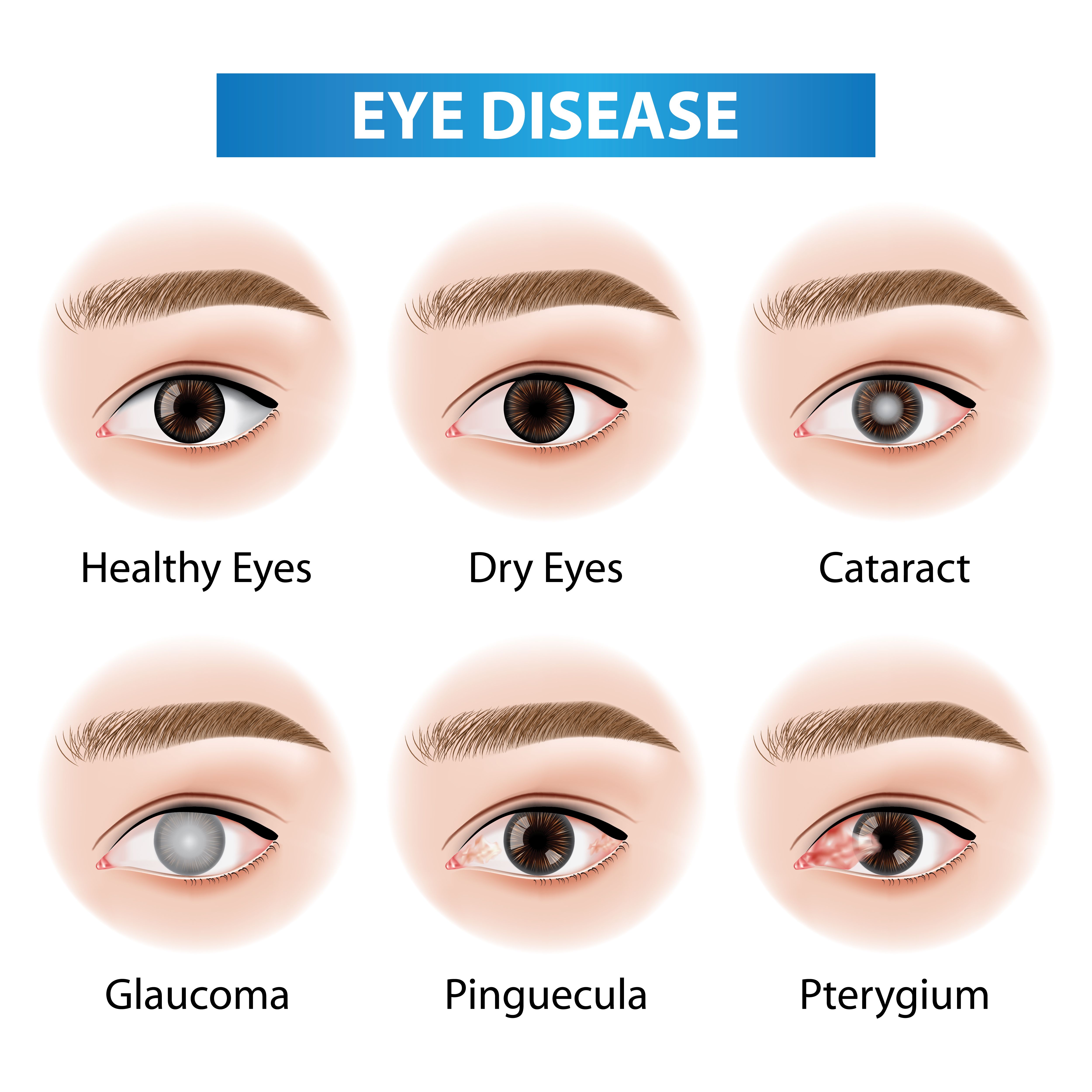 Eye Disease Treatment | Eye Center of Virginia in Williamsburg VA