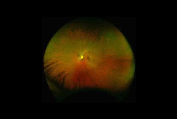 Optos Retinal Imaging