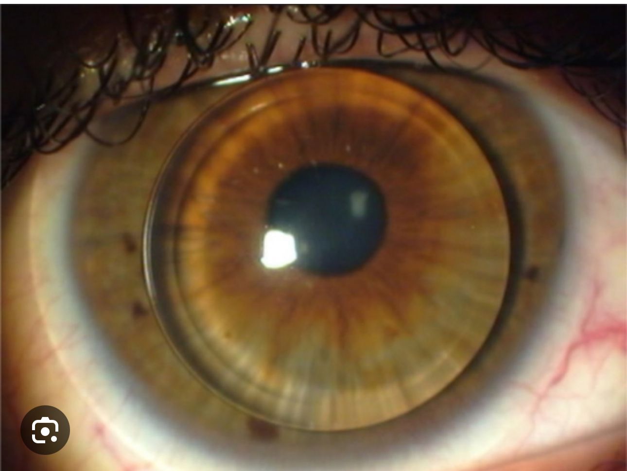 Scleral Contact Lenses | Dussan Eye Care