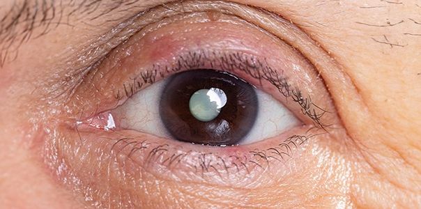 Cataract Treatment | Duvall Advanced Family Eye Care