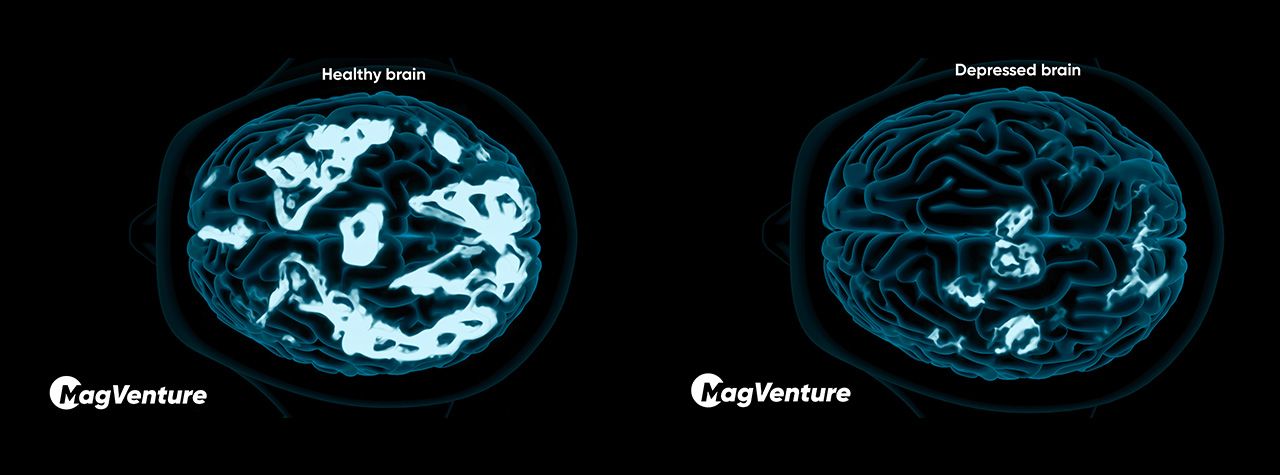Transcranial magnetic Stimulation |Trusted Pain and Wellness Clinic in Reno