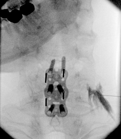 Spine Procedures in Scottsdale, AZ | Jacob T. Rohrs, M.D.