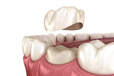 Cosmetic Dentistry in Culver City CA Before & After