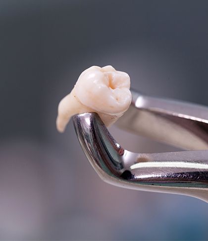 Tooth Extractions | Dentist in Pasadena