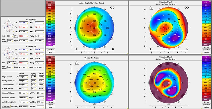 Keratoconus And Your Treatment Options