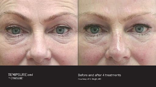 Cynosure Tempsure Envi