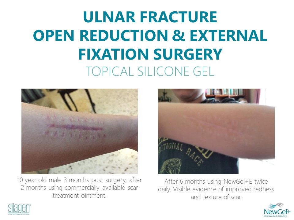 Silagen Rapid Recovery Scar System Scottsdale | Just Go Lipo
