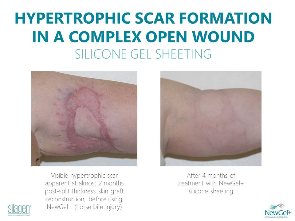 Silagen Rapid Recovery Scar System Scottsdale | Just Go Lipo