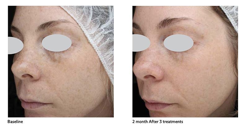 Dry Eye Treatment | San Marino Optometry