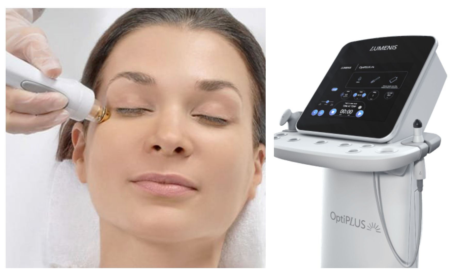 OptiPLUS Radio Frequency Treatment | Dry Eye Optometry Center