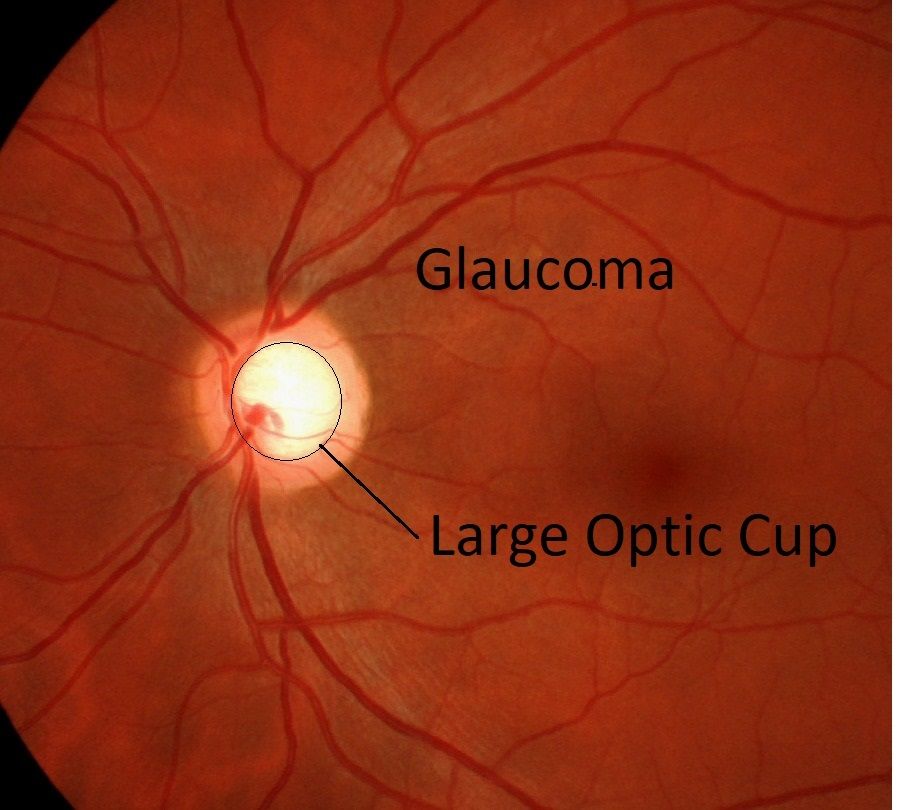 Eye Condition Diagnosis | Eye Doctors in Elmhurst, IL