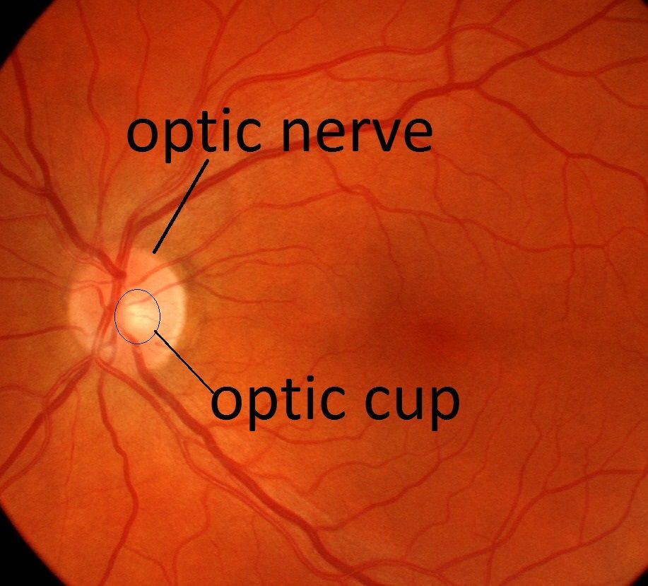 Eye Condition Diagnosis | Eye Doctors in Elmhurst, IL