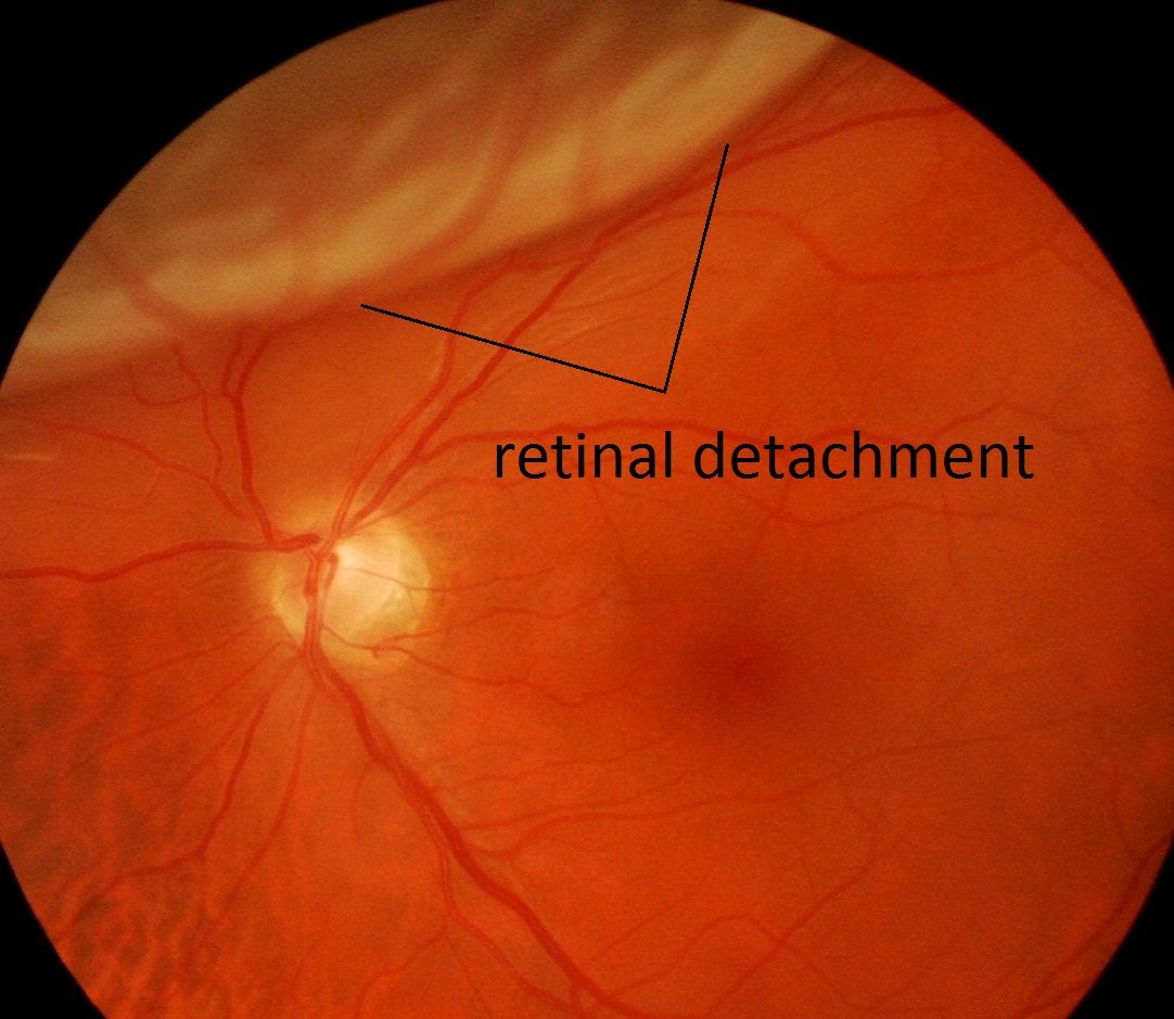 Eye Condition Diagnosis | Eye Doctors in Elmhurst, IL