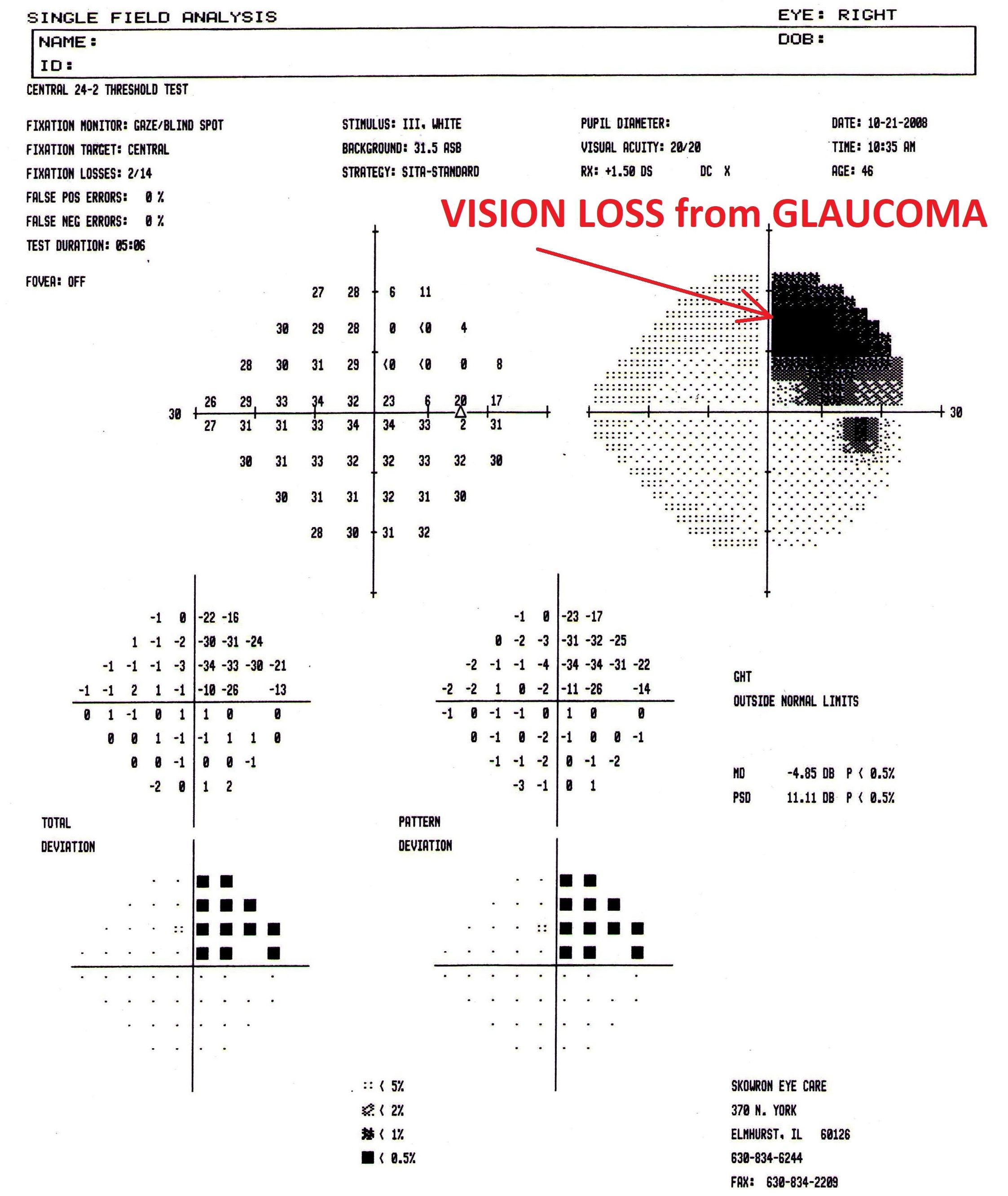 Glaucoma Treatment in Elmhurst, IL | Skowron Eyecare