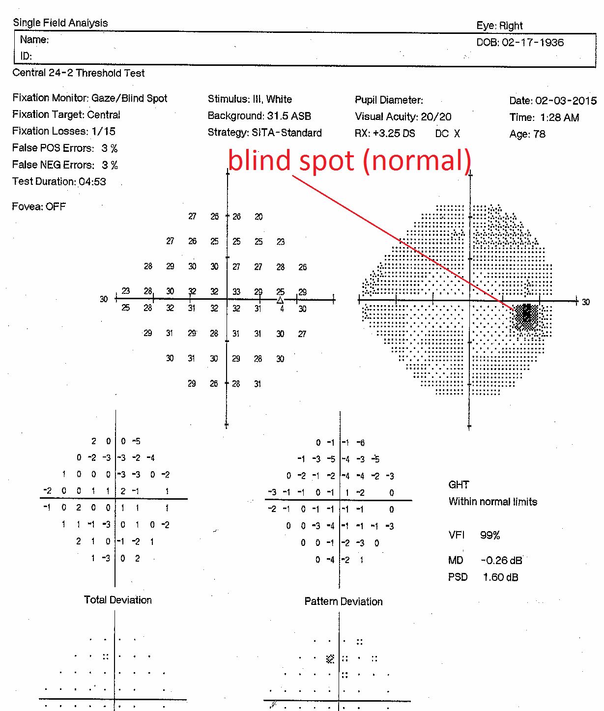 Glaucoma Treatment in Elmhurst, IL | Skowron Eyecare