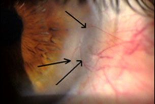 Eye Condition Diagnosis | Eye Doctors in Elmhurst, IL