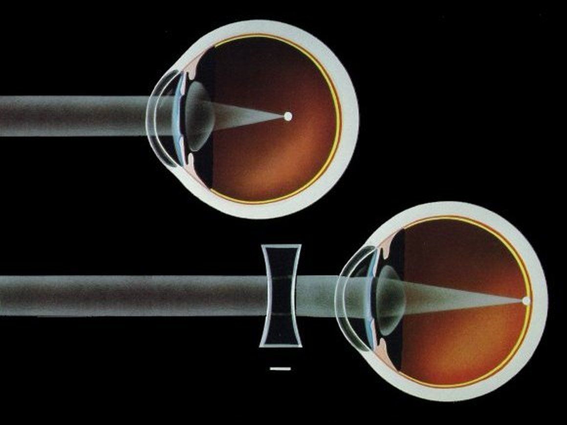 Myopia (Nearsightedness) Diagnosis & Treatment in Elmhurst, IL