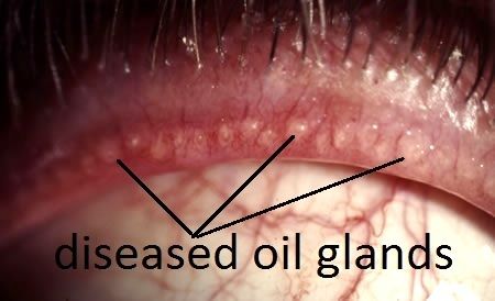 Stye Diagnosis & Treatment in Elmhurst, IL | Skowron Eye Care