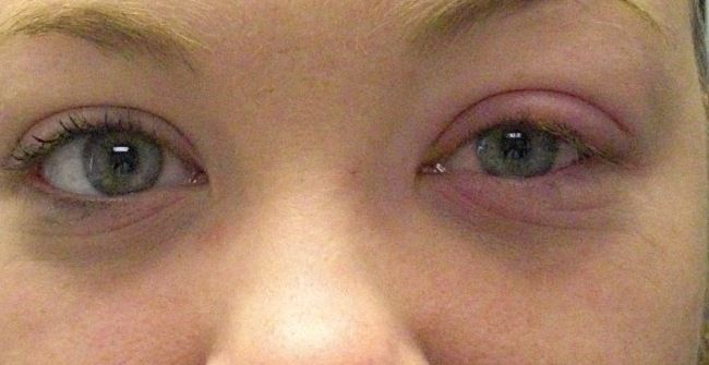 Stye Diagnosis & Treatment in Elmhurst, IL | Skowron Eye Care