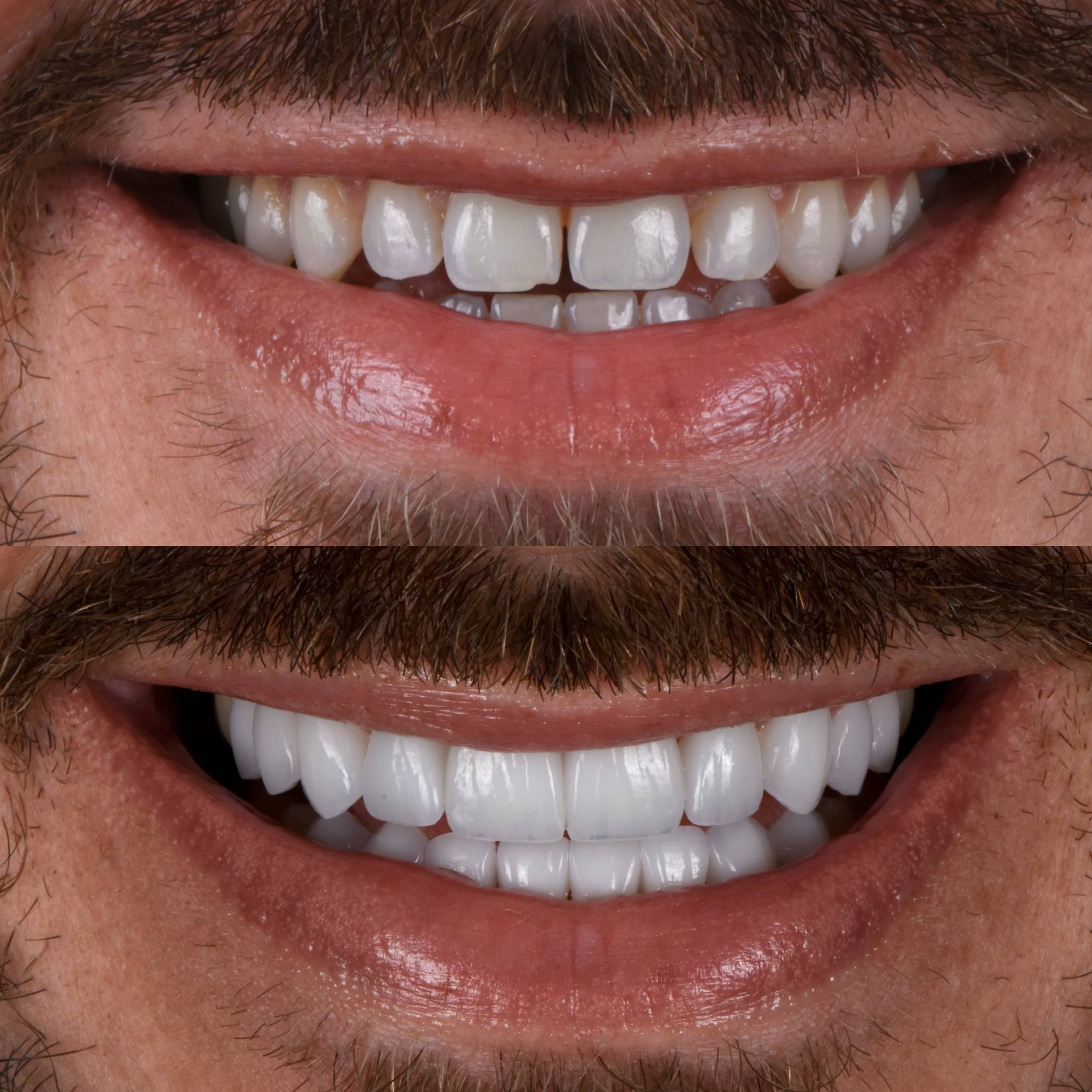 Gallery: Before and After Dental Veneers in Los Angeles, CA | Smiles By ...