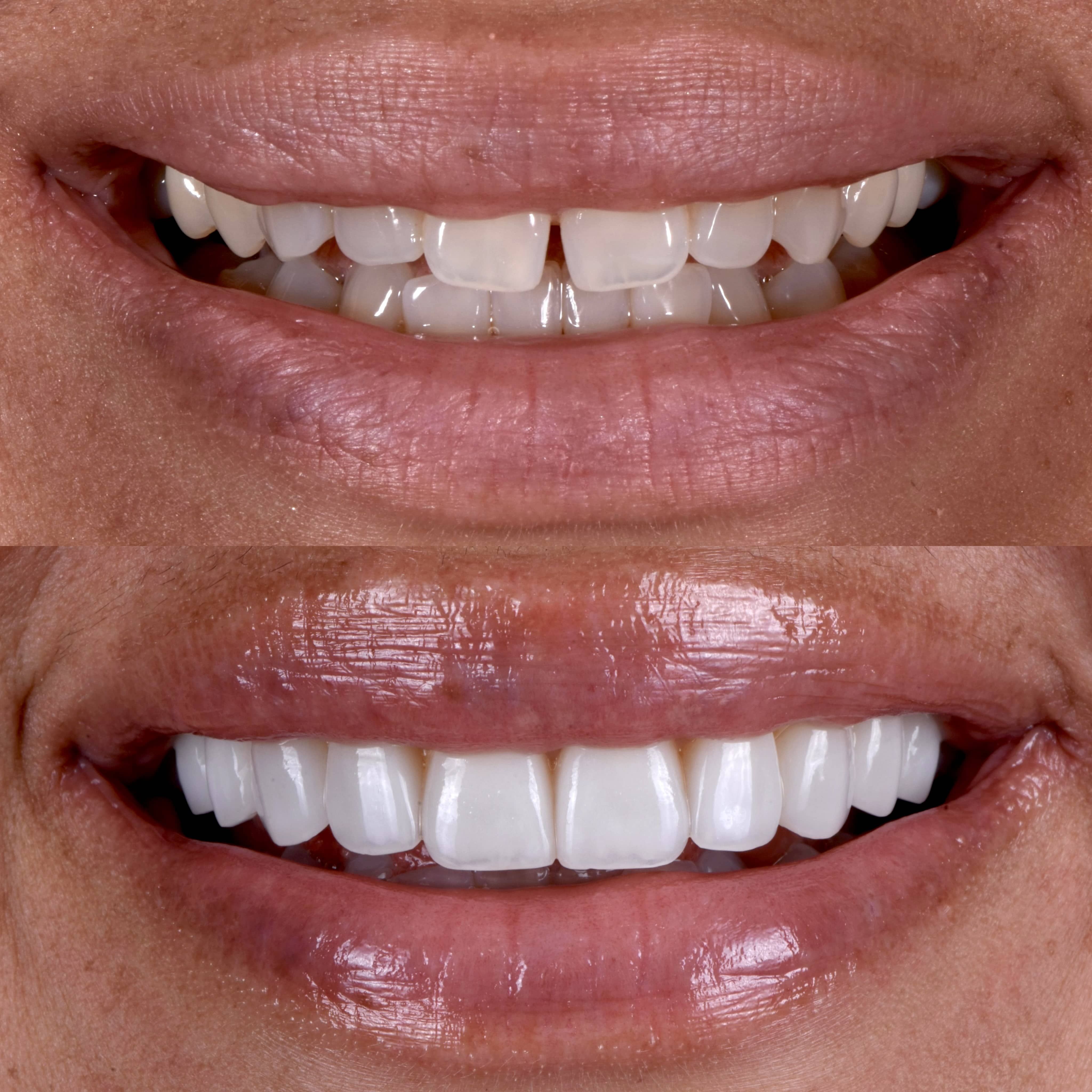 Gallery: Before and After Dental Veneers in Los Angeles, CA | Smiles By ...