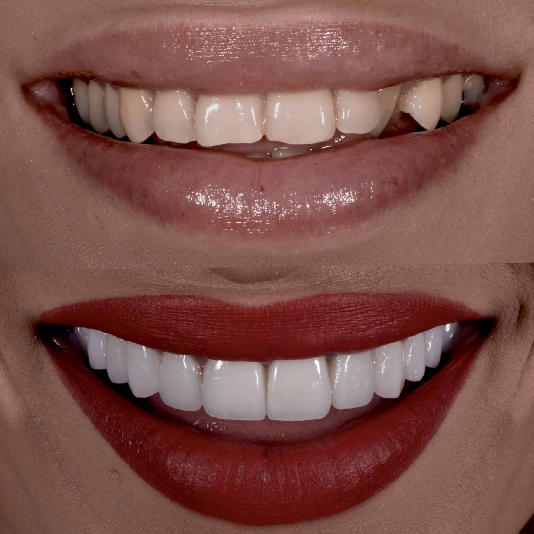 Gallery: Before and After Dental Veneers in Los Angeles, CA | Smiles By ...