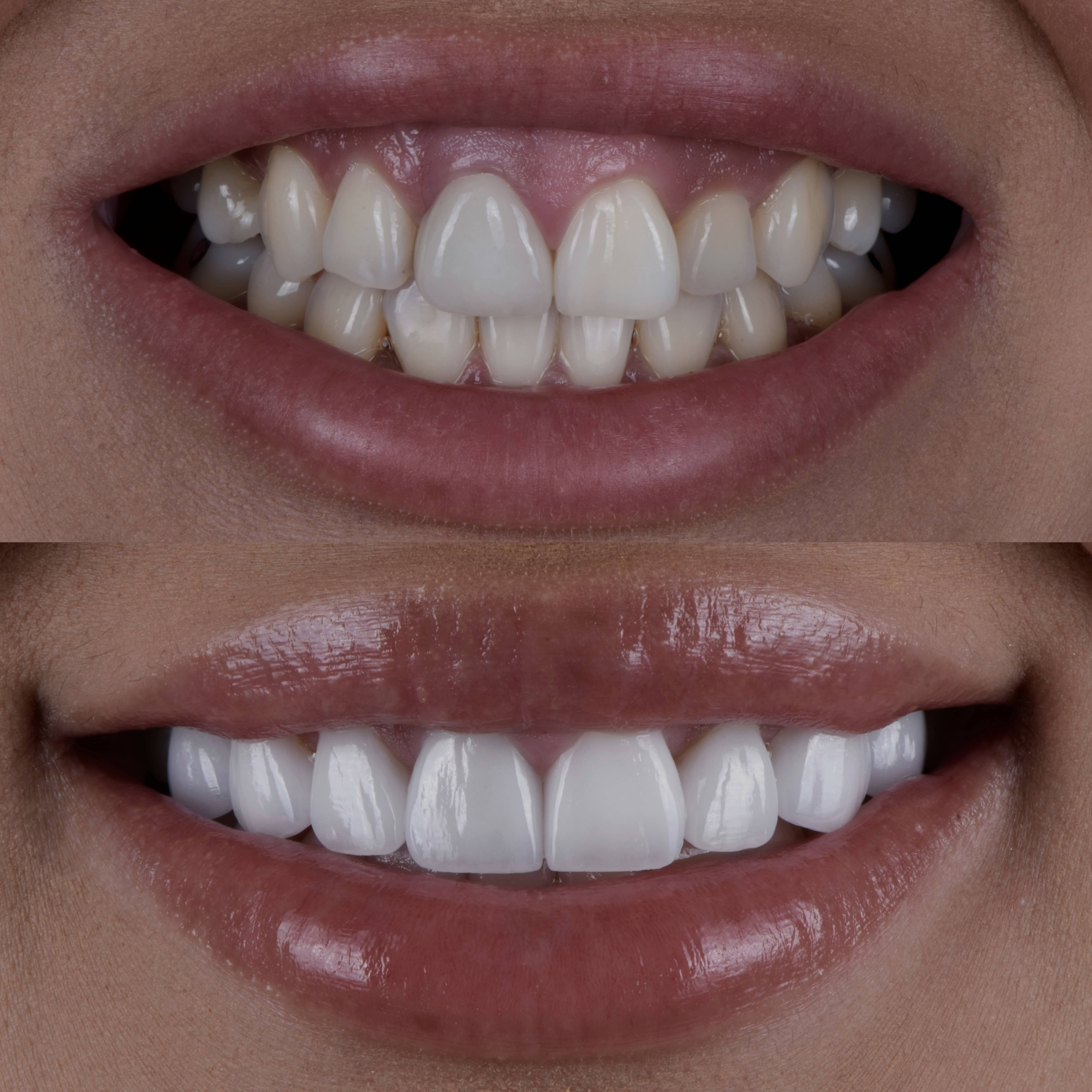 Gallery: Before and After Dental Veneers in Los Angeles, CA | Smiles By ...