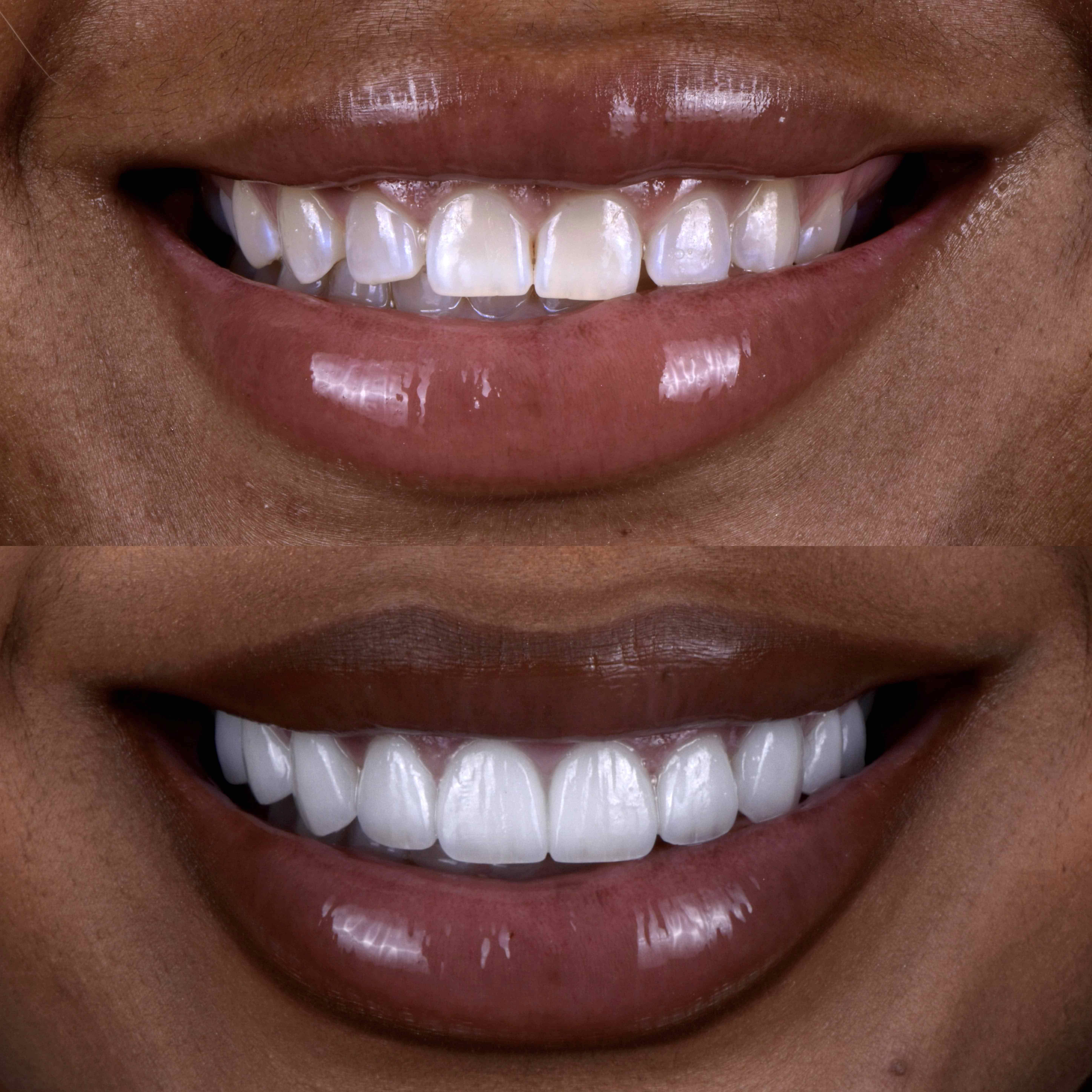 Smiles by Dr. P in Beverly Hills | Veneers Cosmetic Dentist
