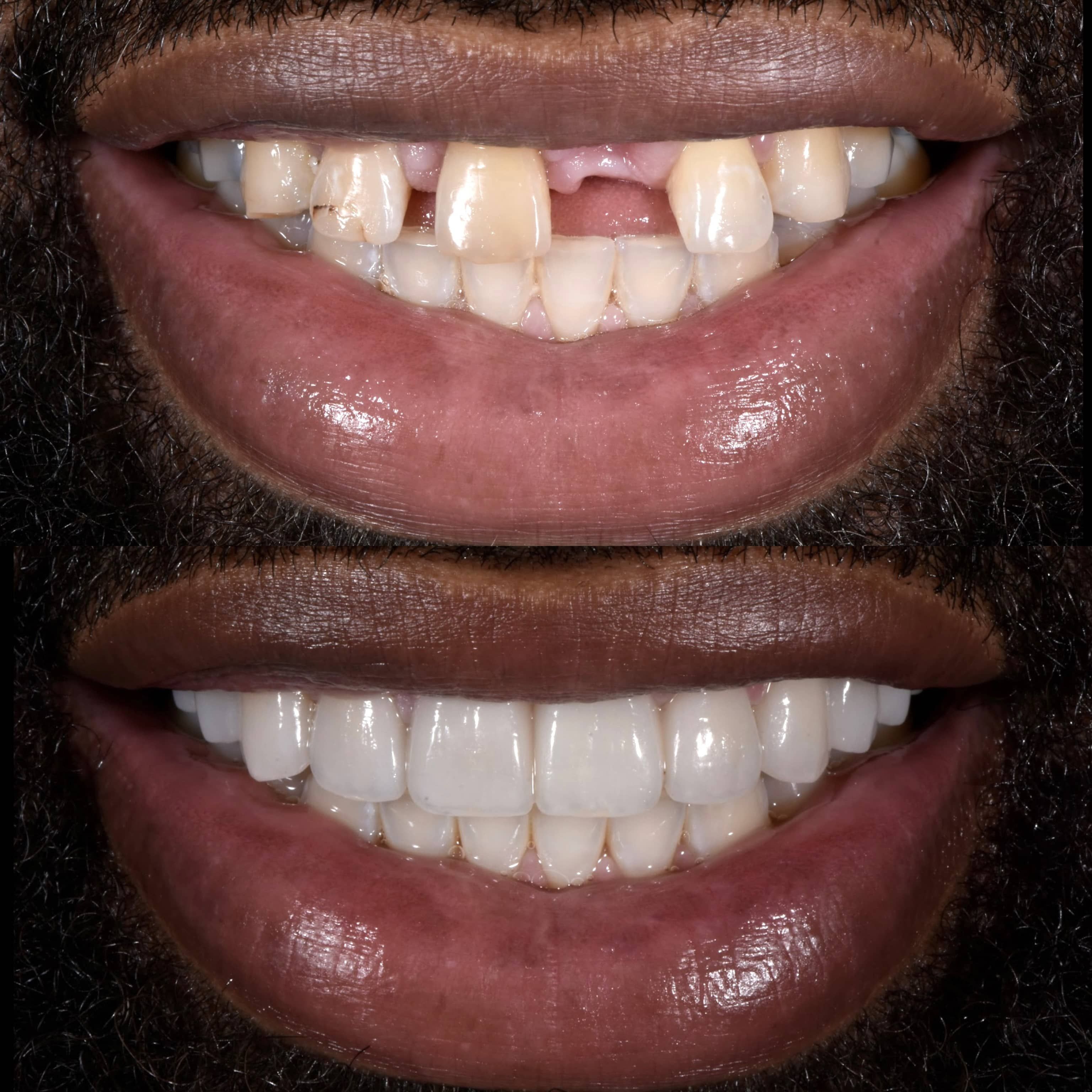 Porcelain Bridges | Smiles by Dr. P in Beverly Hills, CA
