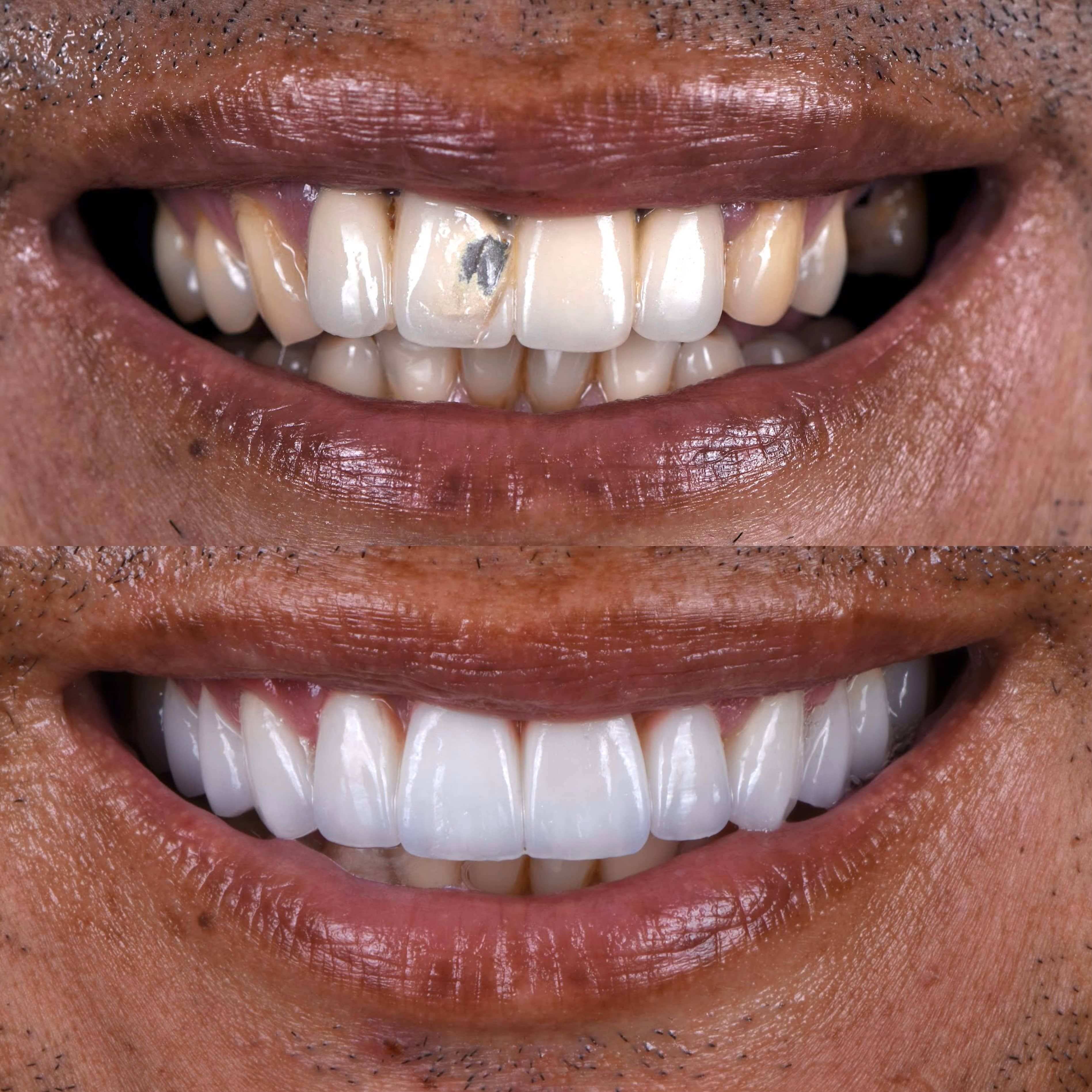 Porcelain Crowns | Smiles by Dr. P in Beverly Hills, CA