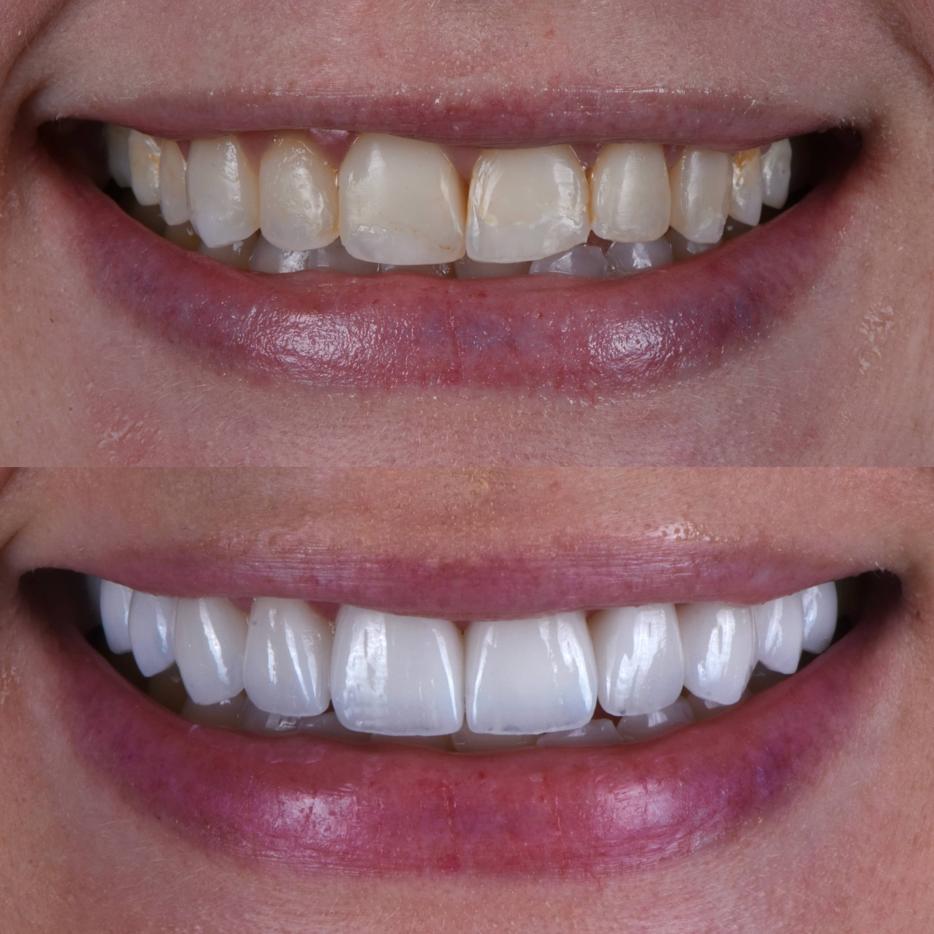 Smiles by Dr. P in Beverly Hills | Veneers Cosmetic Dentist