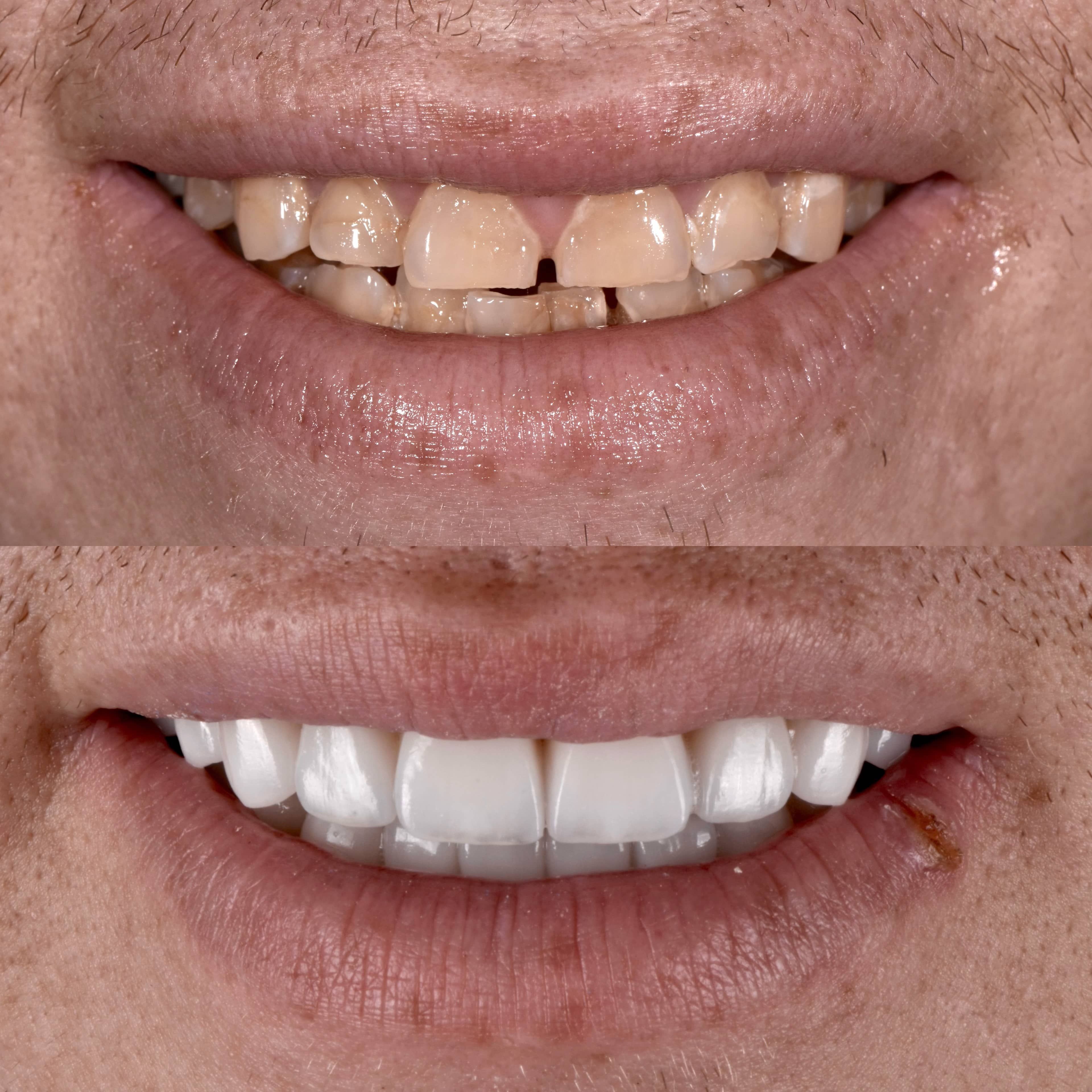 Porcelain Crowns | Smiles by Dr. P in Beverly Hills, CA