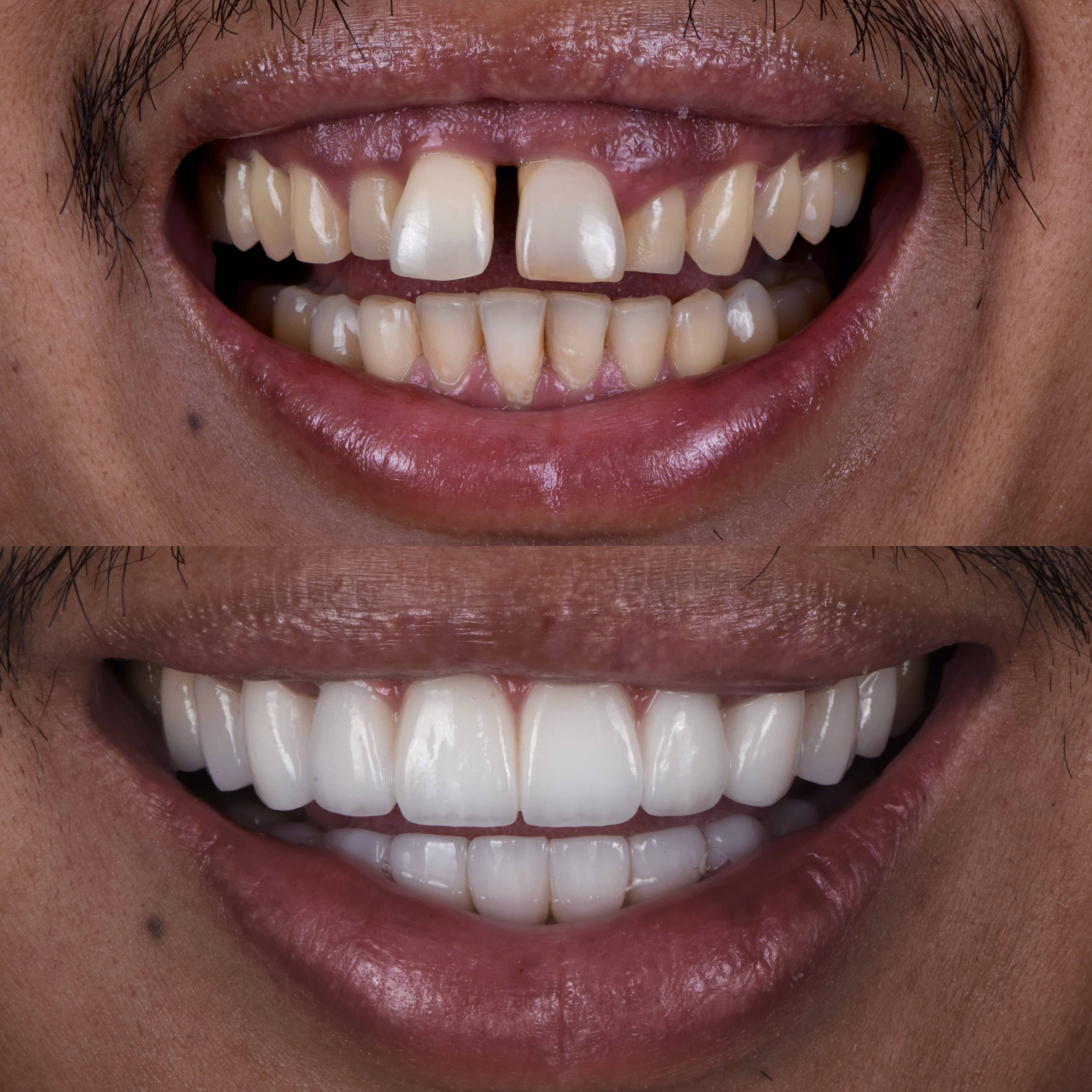 Gallery: Before and After Dental Veneers in Los Angeles, CA | Smiles By ...