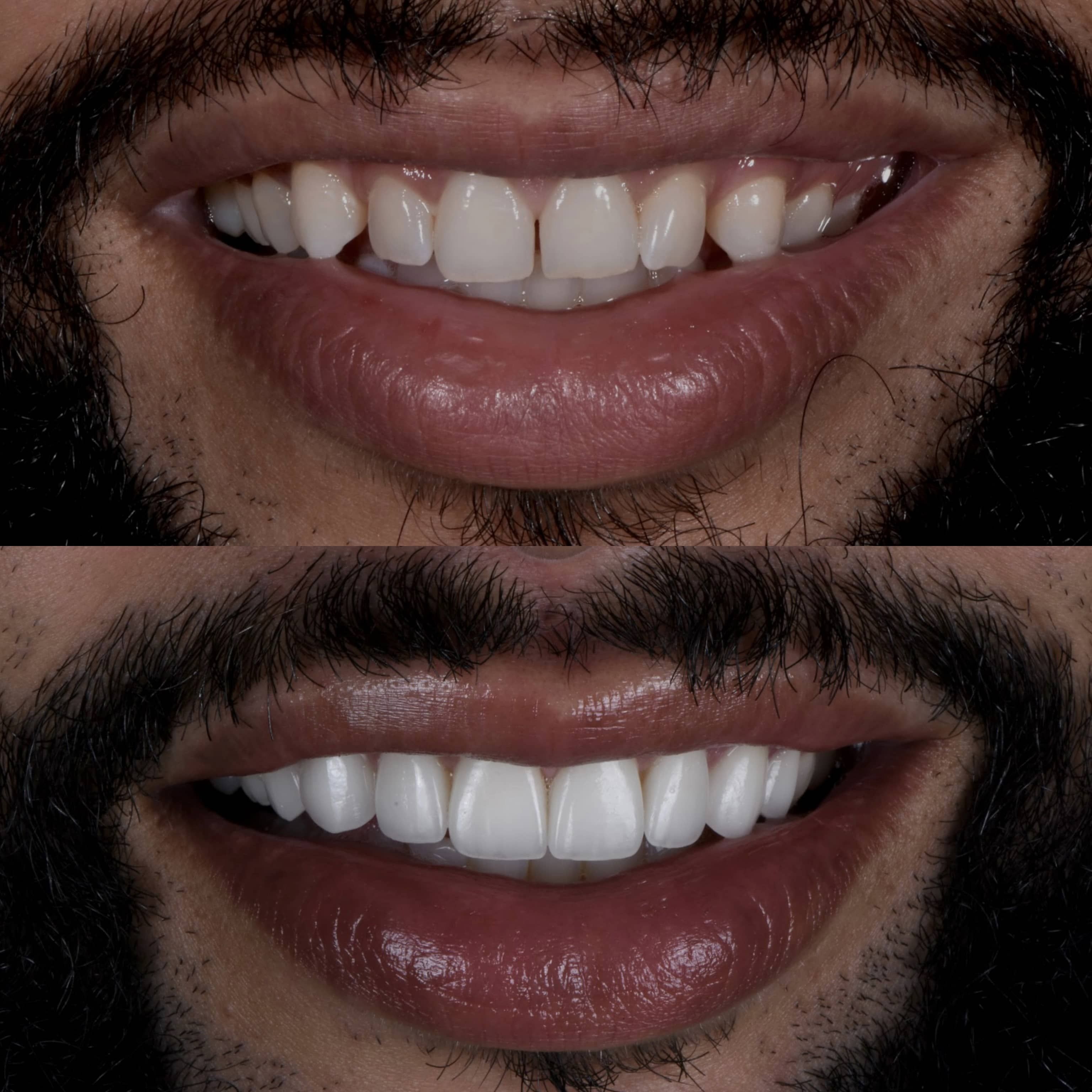 Gallery: Before and After Dental Veneers in Los Angeles, CA | Smiles By ...
