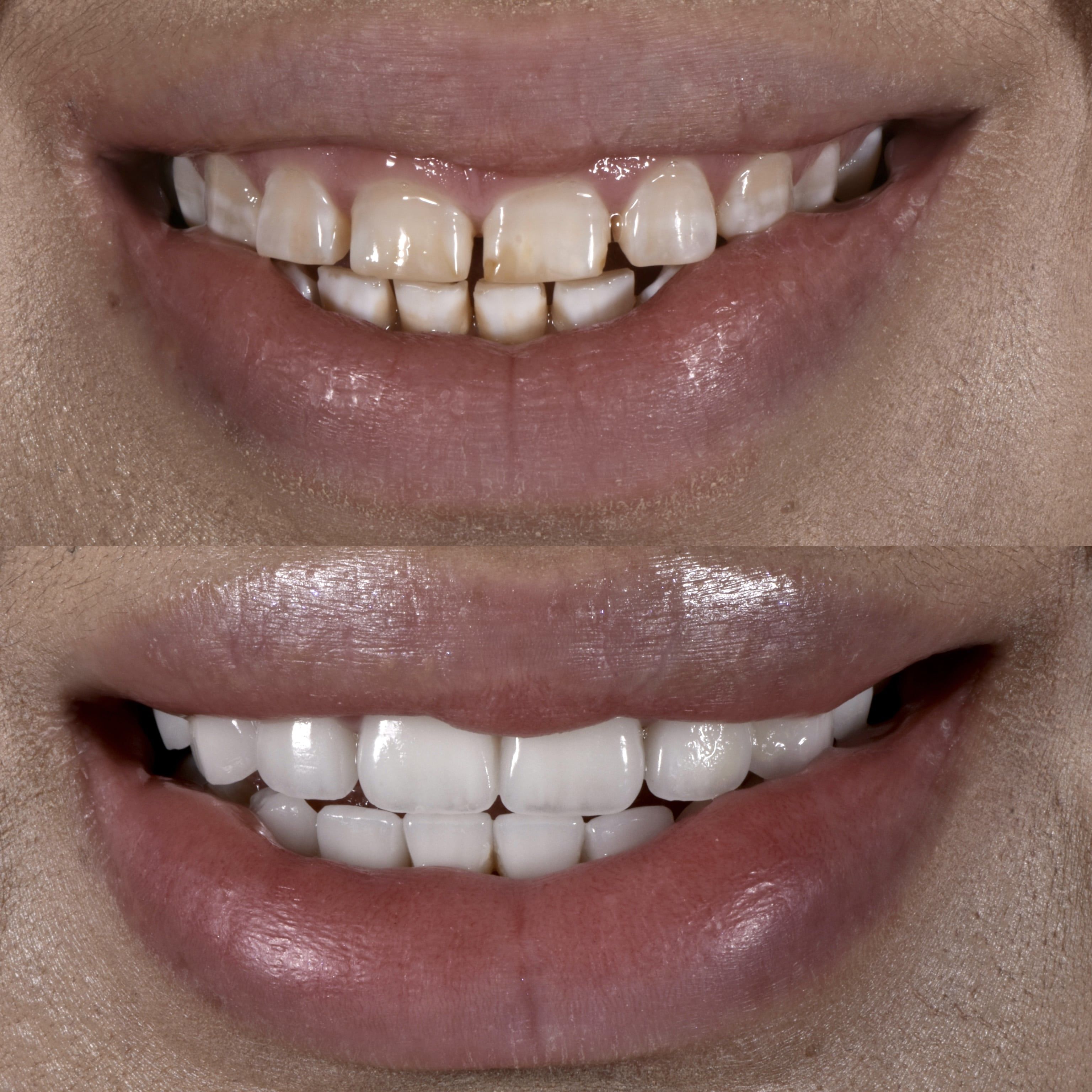 Veneers for Dental Fluorosis | Smiles by Dr. P Beverly Hills