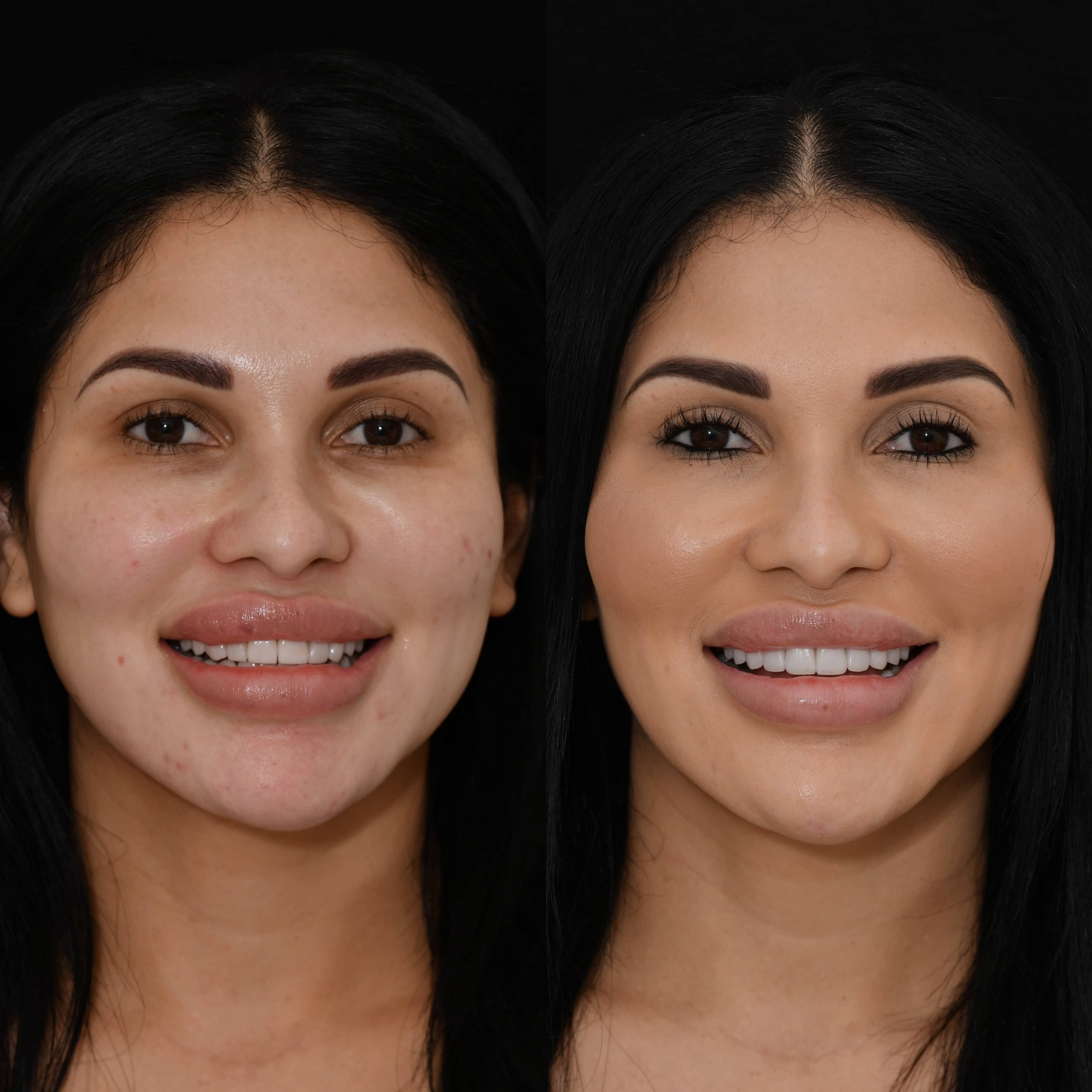 Gallery: Before and After Dental Veneers in Los Angeles, CA | Smiles By ...