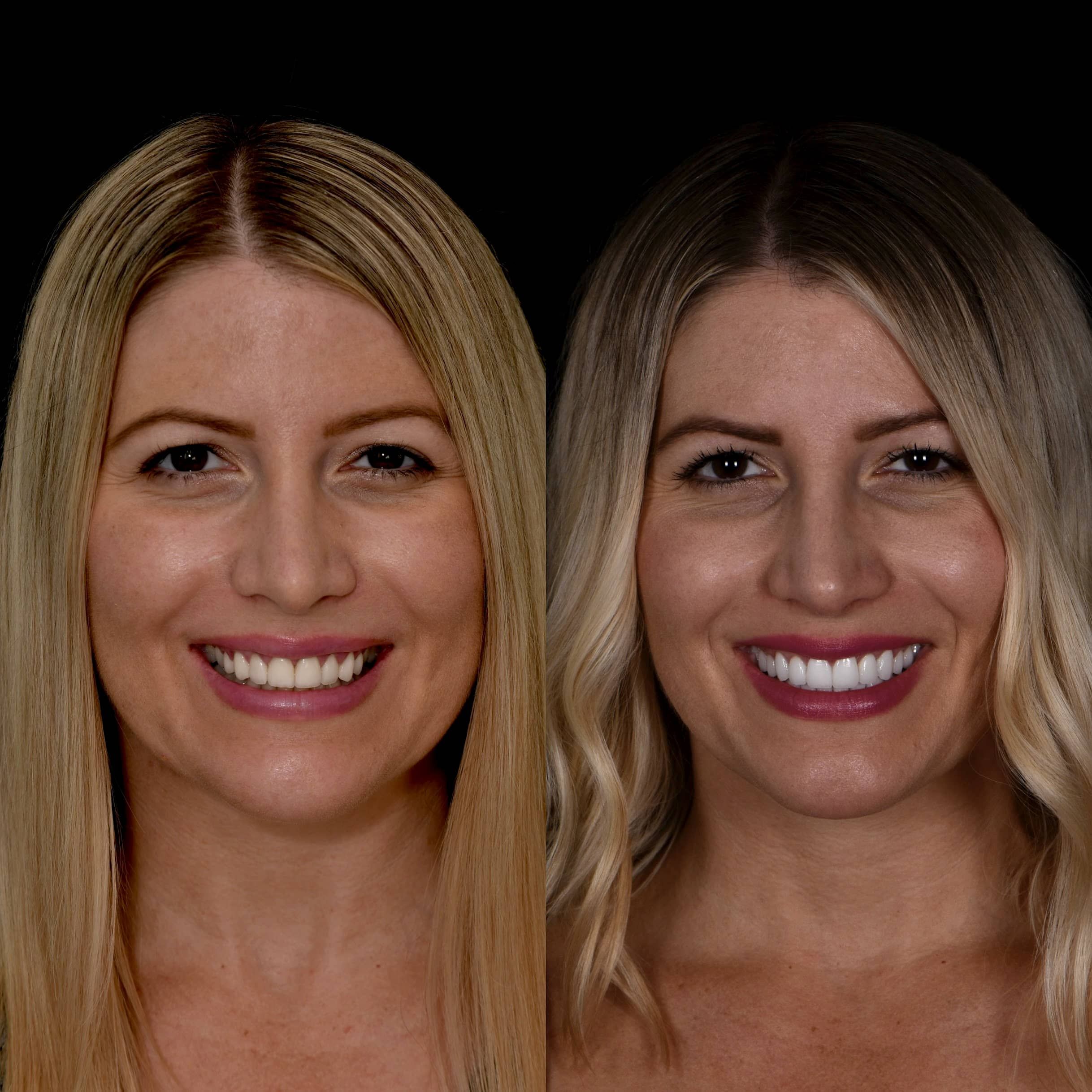 Gallery: Before and After Dental Veneers in Los Angeles, CA | Smiles By ...