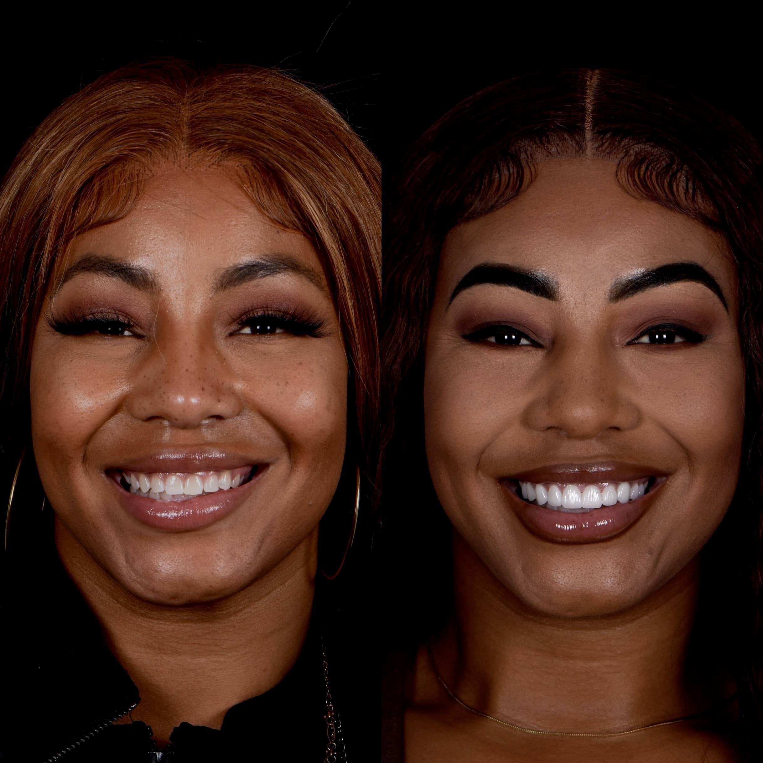 Gallery: Before and After Dental Veneers in Los Angeles, CA | Smiles By ...