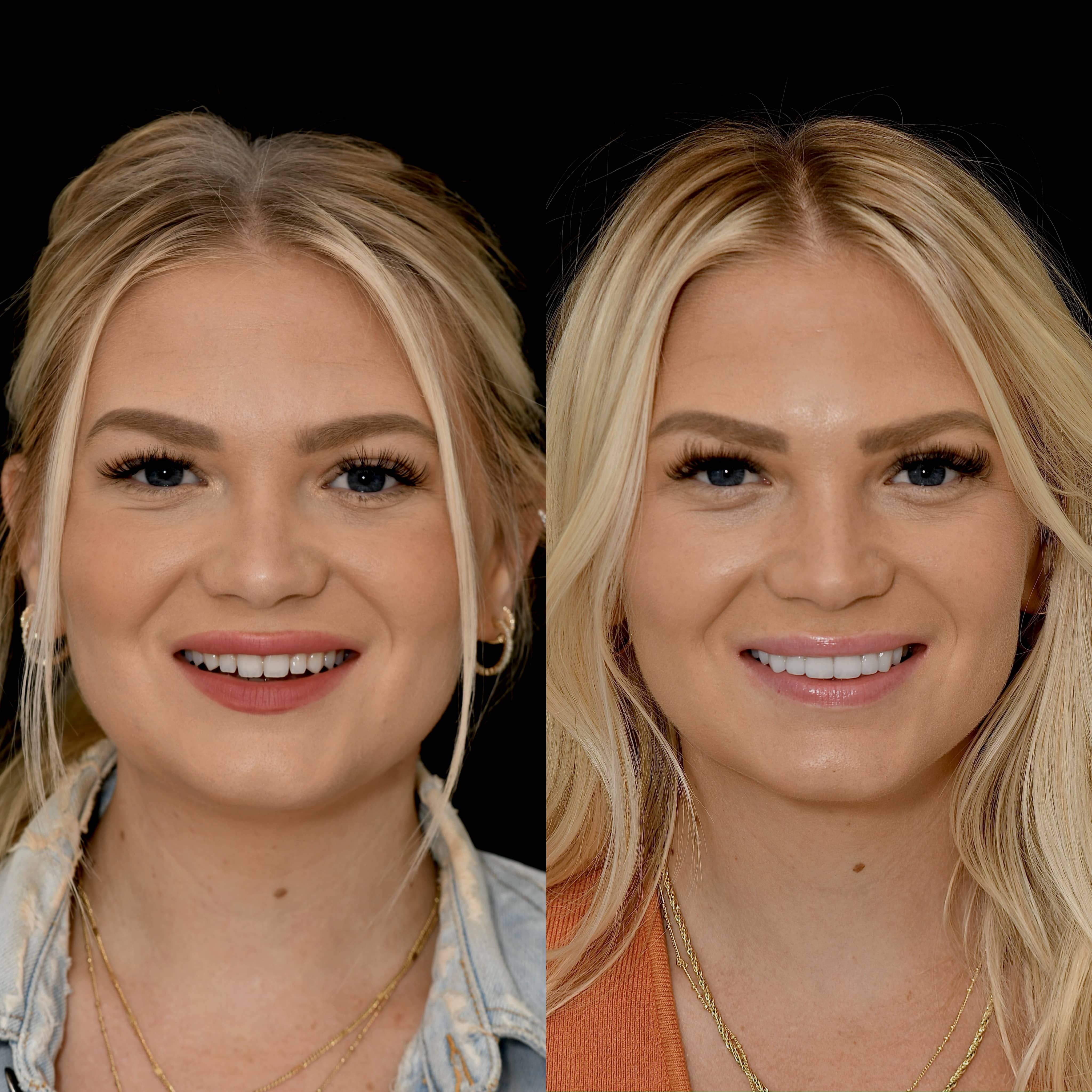 Gallery: Before and After Dental Veneers in Los Angeles, CA | Smiles By ...