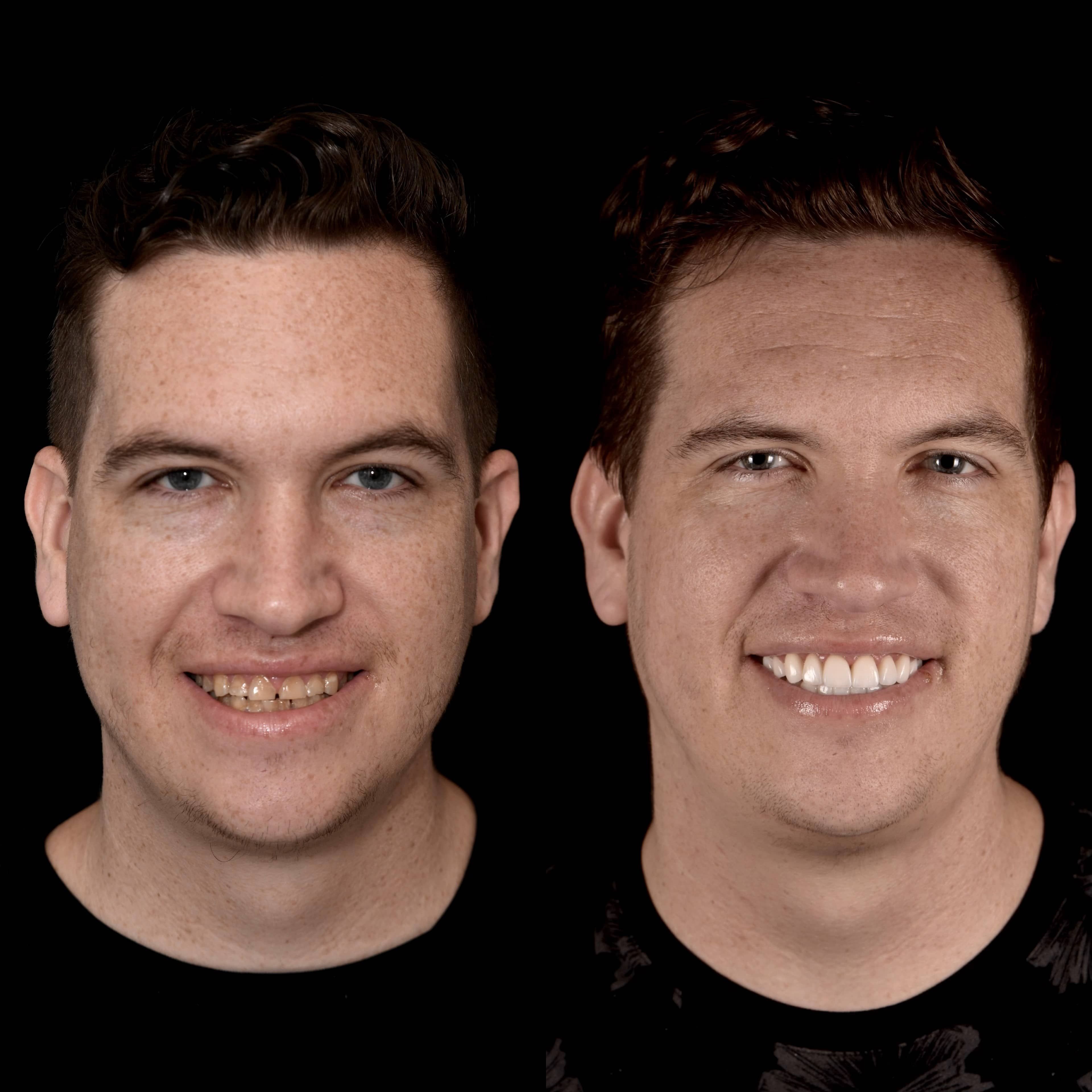 Gallery: Before and After Dental Veneers in Los Angeles, CA | Smiles By ...