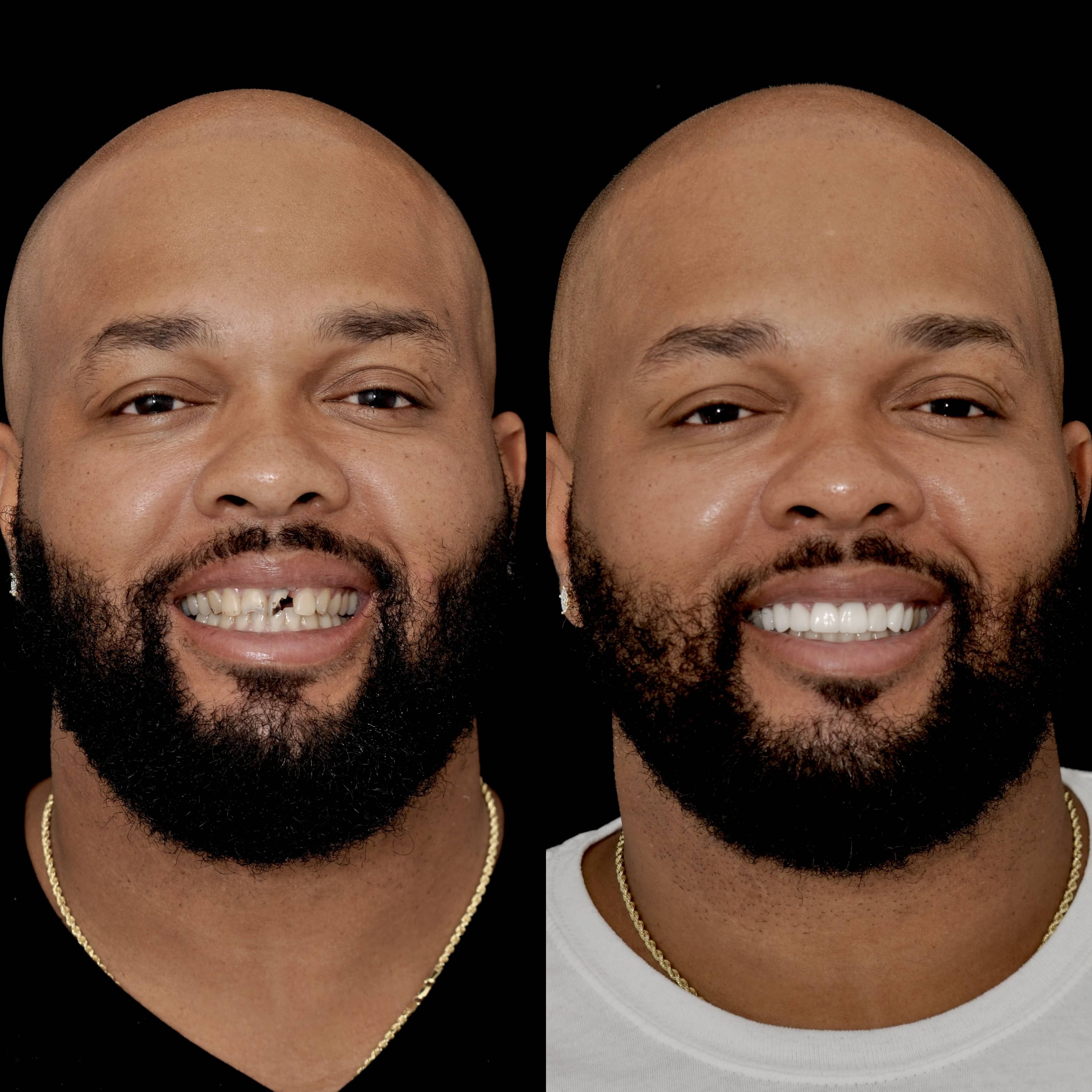 Gallery: Before and After Dental Veneers in Los Angeles, CA | Smiles By ...