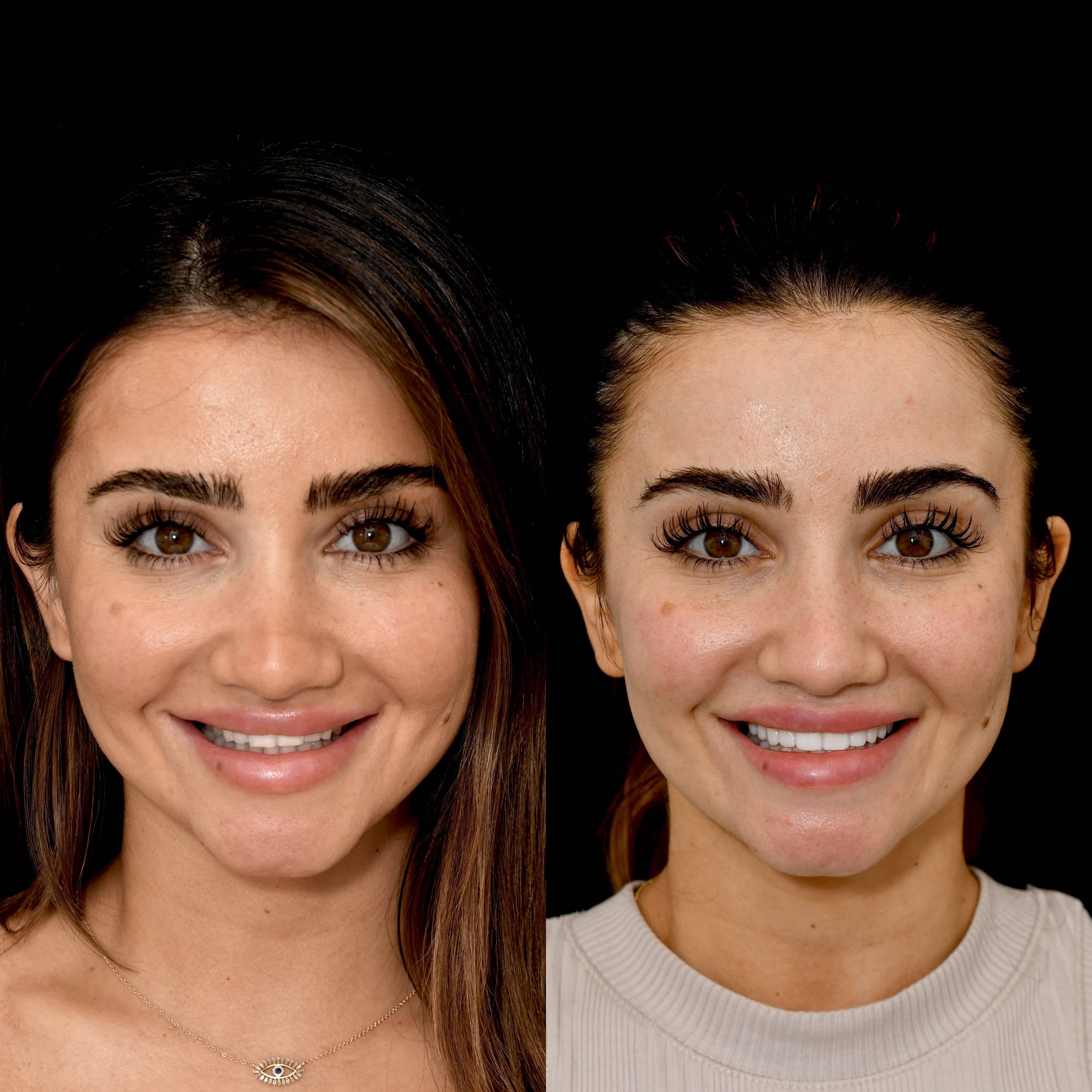 Gallery: Before and After Dental Veneers in Los Angeles, CA | Smiles By ...