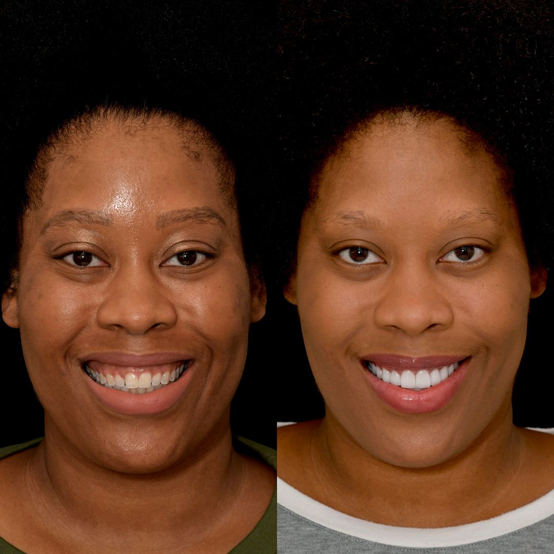 Gum Lift and Contouring | Smiles by Dr. P in Beverly Hills