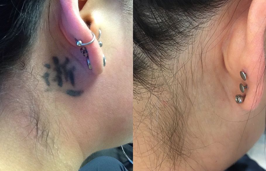 Mobile Tattoo Removal Experts | Tattoo Removal for Inmates