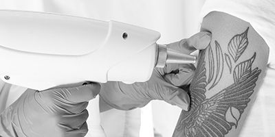 Ink Doctors Mobile Tattoo Removal Experts