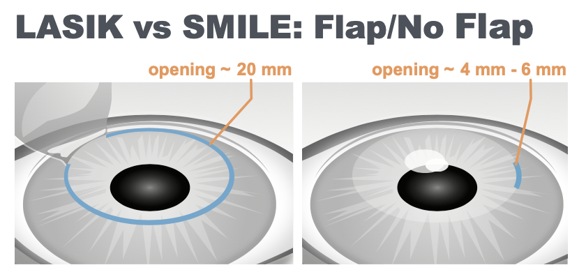 SMILE | Laser Vision Correction Procedure | Eyesight | Eyes